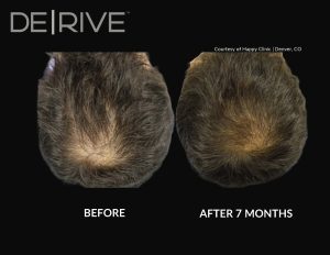 Hair Restoration Boynton Beach | DERIVE